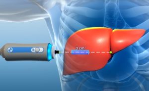 What Is A Liver Scan? - Arizona Liver Health